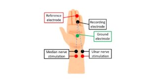 EMG method part 1: Carpal tunnel syndrome | 初心者でもよくわかる筋電図 ...