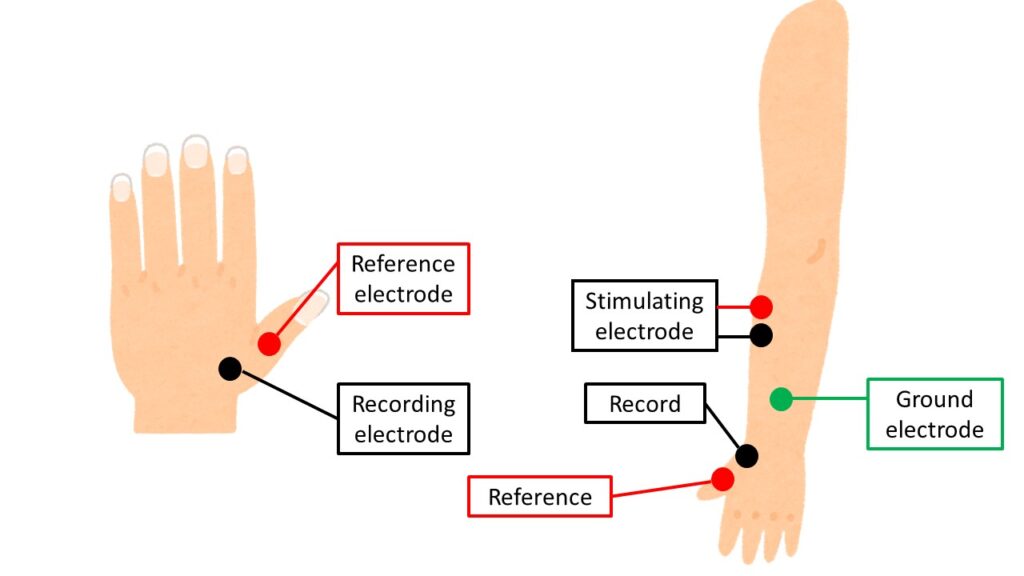 EMG basics part 5: Electrode position for nerve conduction test (median ...