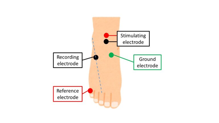 EMG basics part 6: Electrode position for nerve conduction test (tibia ...